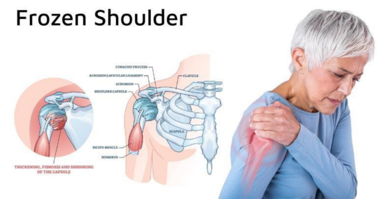 A Comprehensive Guide to Treating Frozen Shoulders in Bangalore ...